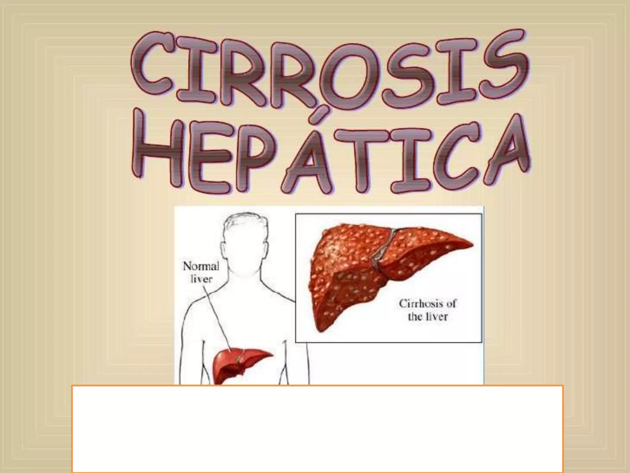 Cirrosis hepatica | PPTX