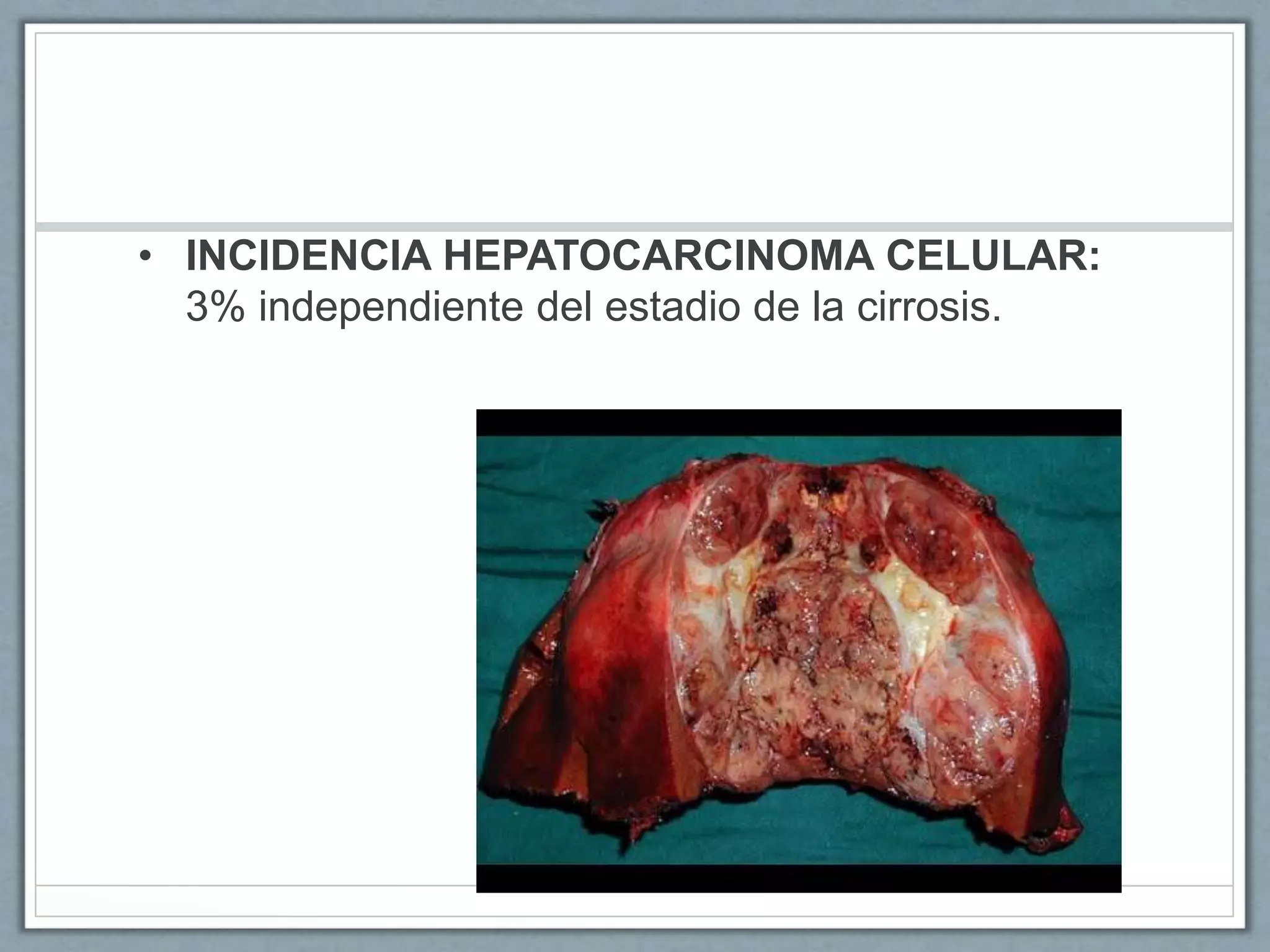 Cirrosis hepática e hipertensión portal, Complicaciones: Ascitis ...