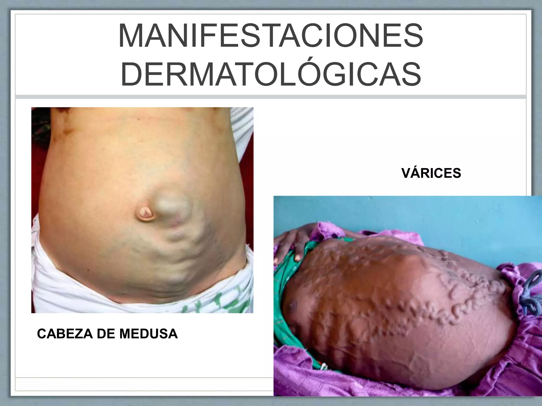 Cirrosis Hepática E Hipertensión Portal Complicaciones Ascitis