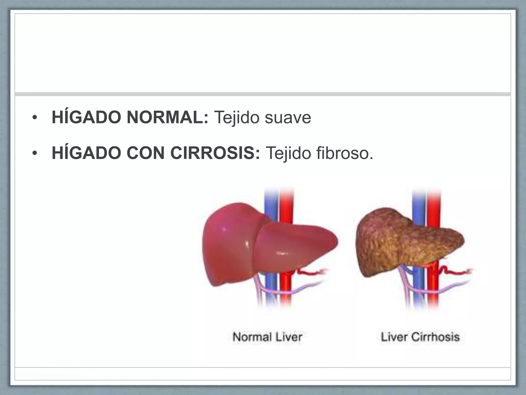 Cirrosis hepática e hipertensión portal, Complicaciones: Ascitis ...