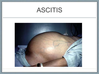 Cirrosis hepática e hipertensión portal, Complicaciones: Ascitis ...
