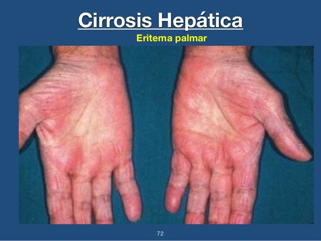 Cirrosis hepatica slideshare