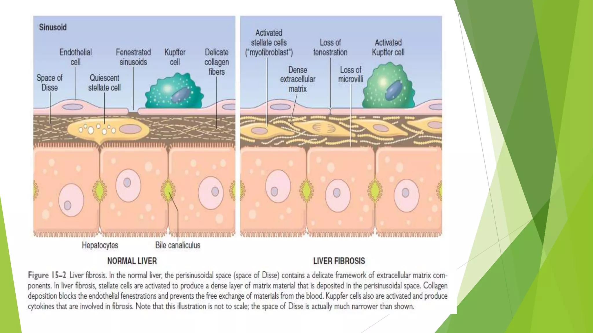 Cirrosis of liver and its complication and traetment of hep b and c | PPTX