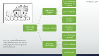 Cirugía oral - INCISION Y COLGAJO | PPTX