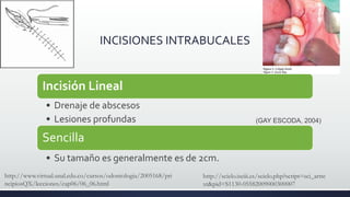 Cirugía oral - INCISION Y COLGAJO | PPTX