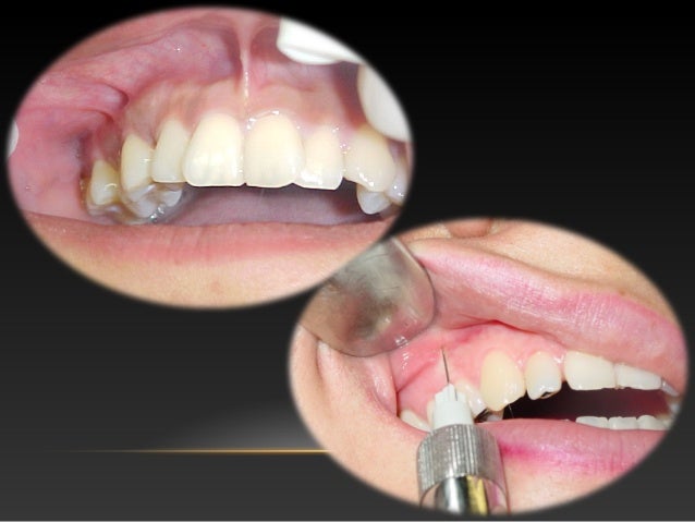 Tecnica de Anestesia Local