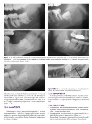 Cirugía clasificaciones posicion tercer molar | PDF