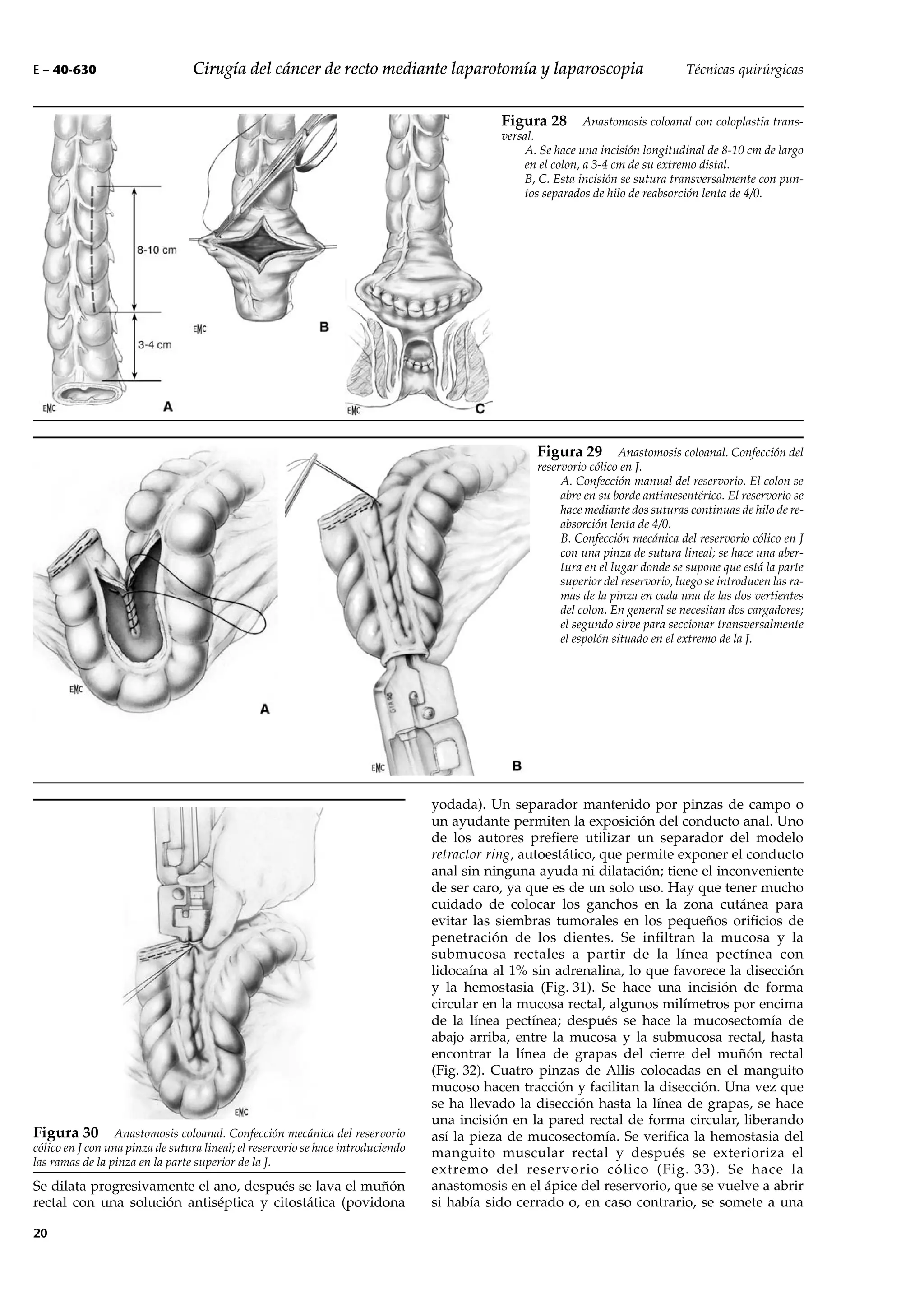 EMC. Cirugía del cáncer de recto mediante laparotomía y laparoscopia | PDF