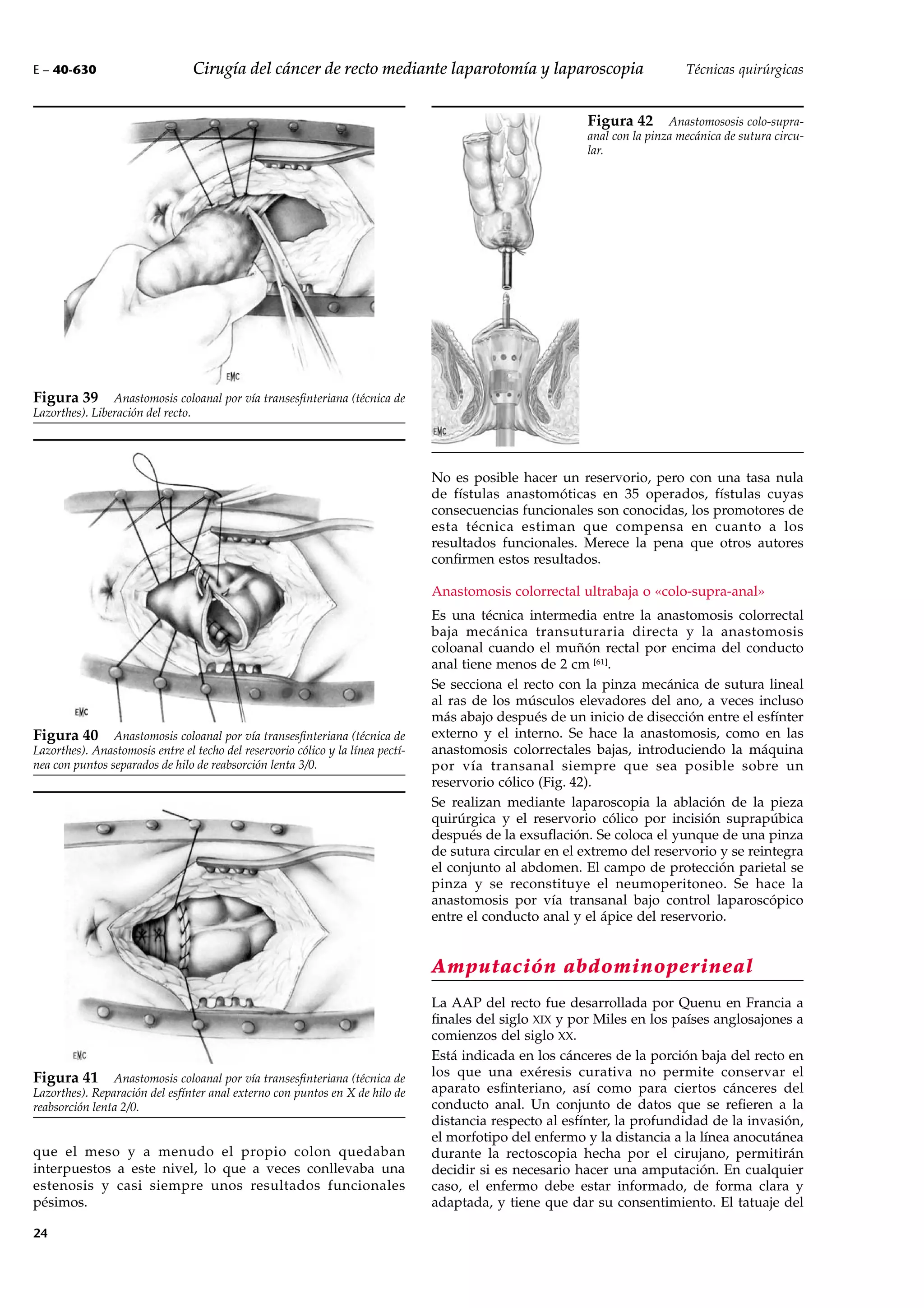 EMC. Cirugía del cáncer de recto mediante laparotomía y laparoscopia | PDF