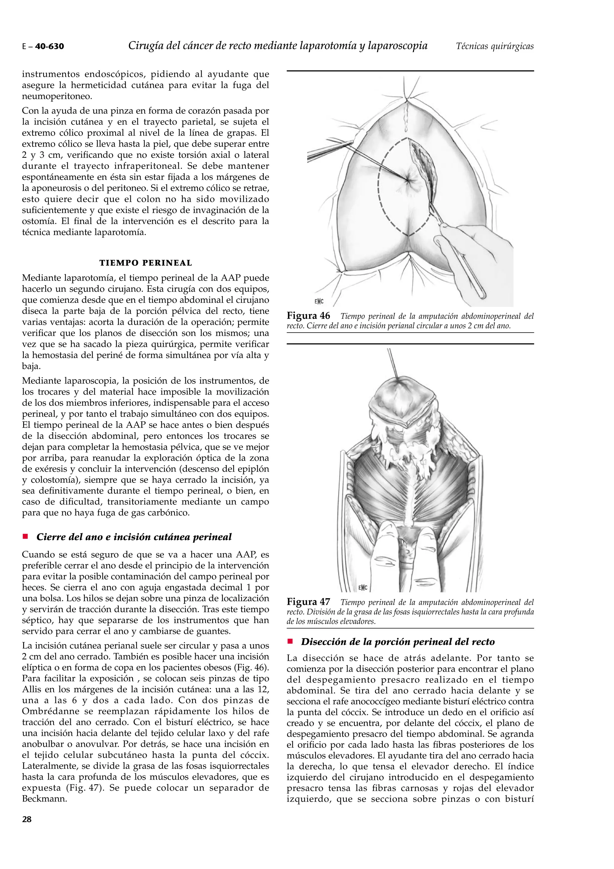 EMC. Cirugía del cáncer de recto mediante laparotomía y laparoscopia | PDF