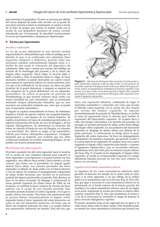 EMC. Cirugía del cáncer de recto mediante laparotomía y laparoscopia | PDF