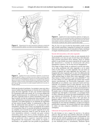 EMC. Cirugía del cáncer de recto mediante laparotomía y laparoscopia | PDF