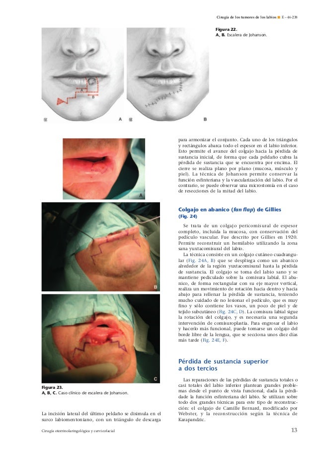 Cirugía de los tumores de los labios