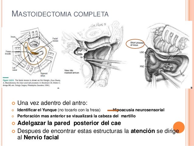 Cirugía de mastoides y apex petroso r2