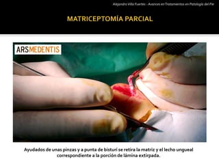 Cirugía en onicocriptosis y exostosis subungueal | PDF