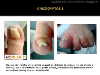 Cirugía en onicocriptosis y exostosis subungueal | PDF