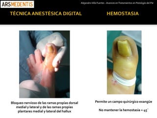 Cirugía en onicocriptosis y exostosis subungueal | PDF