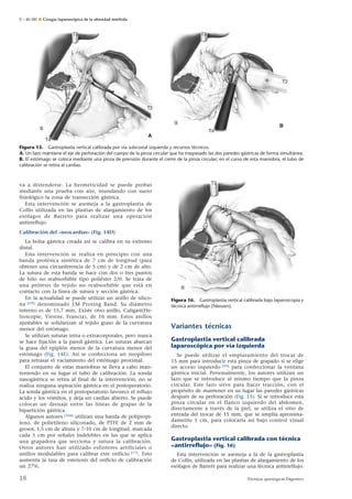 EMC. Cirugía laparoscópica de la Obesidad Mórbida | PDF