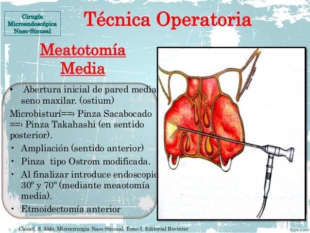 Cirugía Microendoscópica Nasosinusal