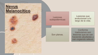 Cirugías Dermatológicas: nevus y lipoma | PPTX