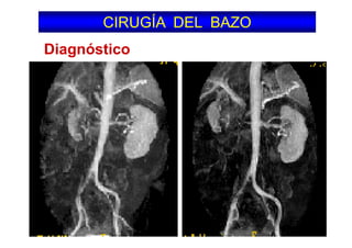Fisiopatologia de bazo | PDF