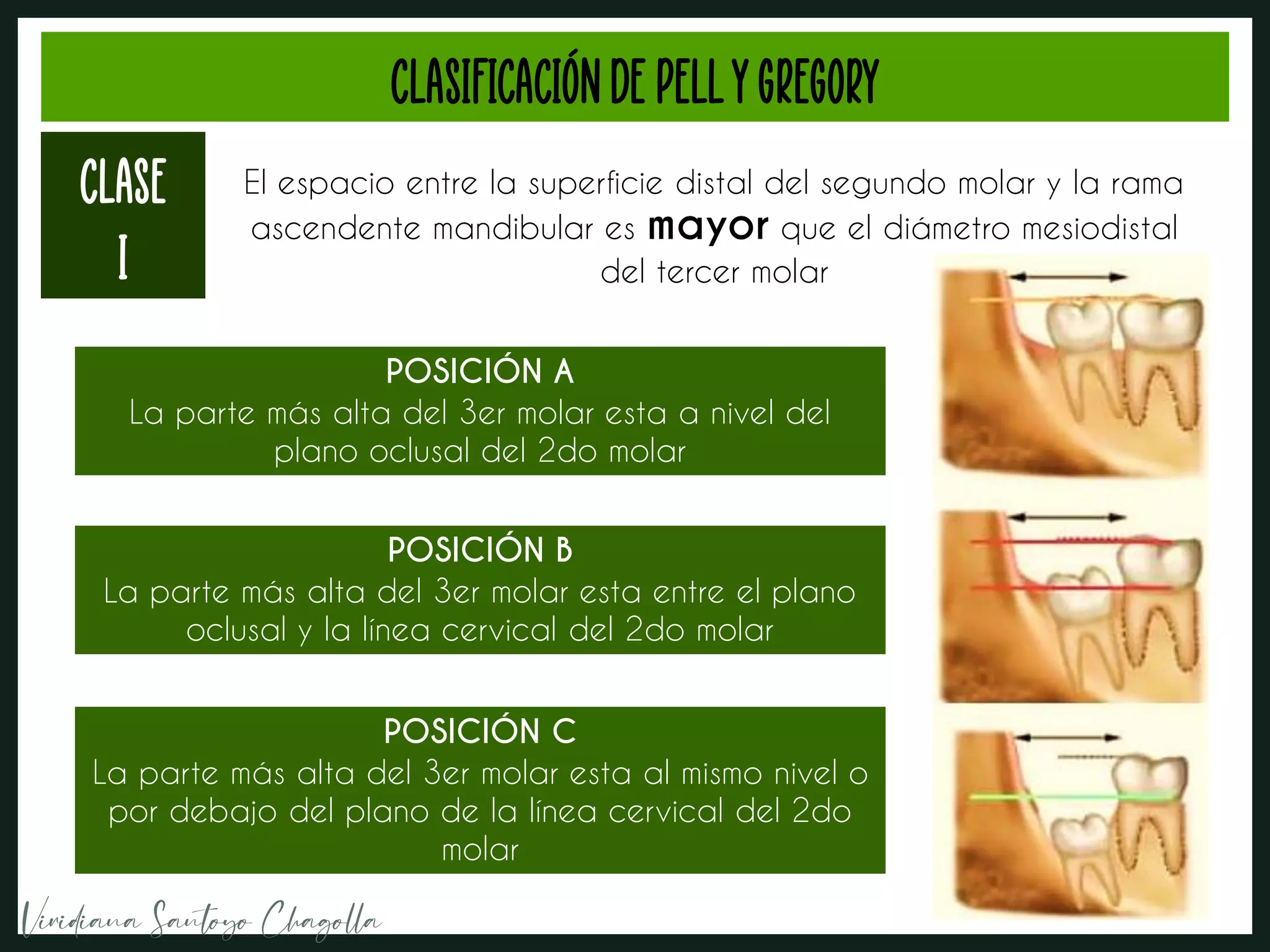 CIRUGIA BUCAL- clasificación de winter pell y gregory.pdf