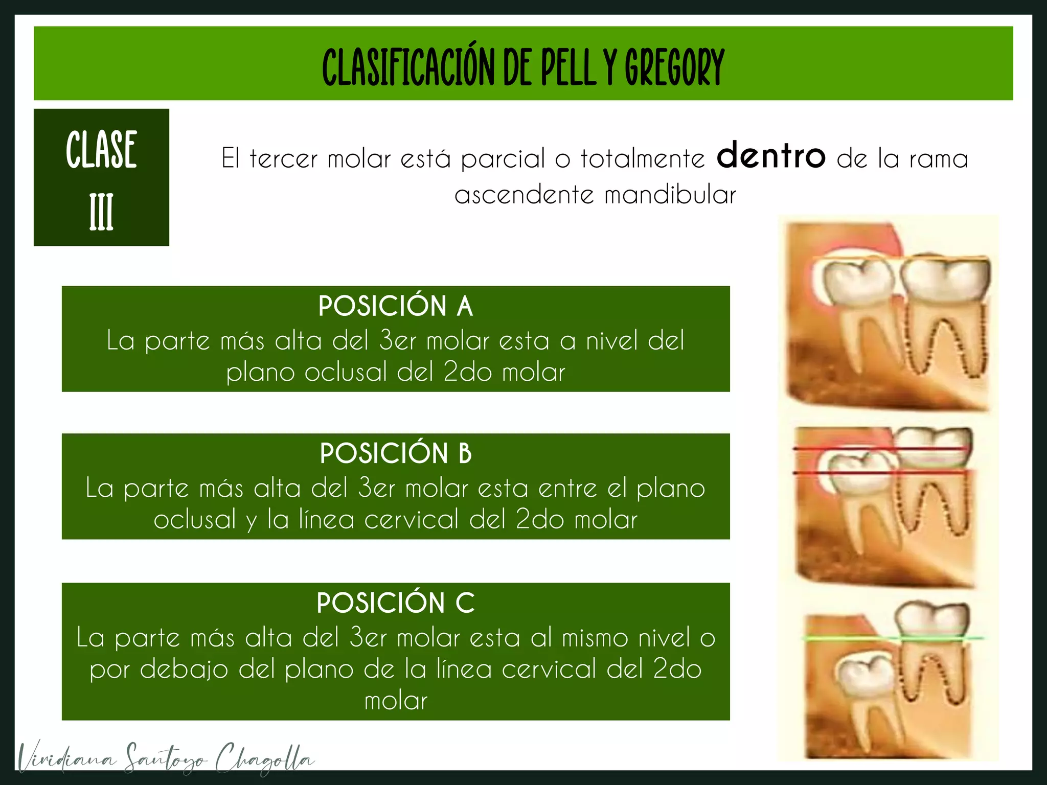 CIRUGIA BUCAL- clasificación de winter pell y gregory.pdf