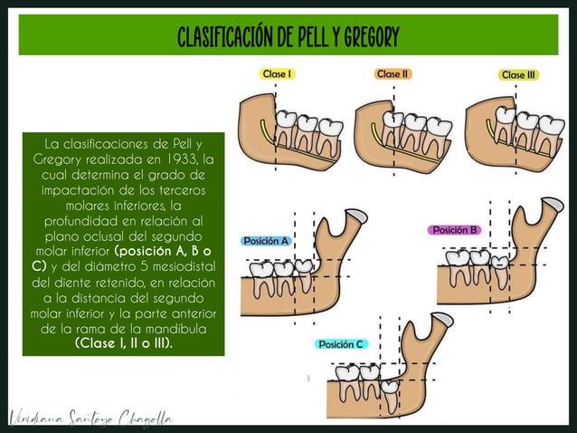 CIRUGIA BUCAL- clasificación de winter pell y gregory.pdf