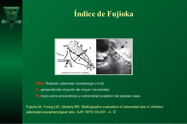 Cirugia de adenoides endoscópica