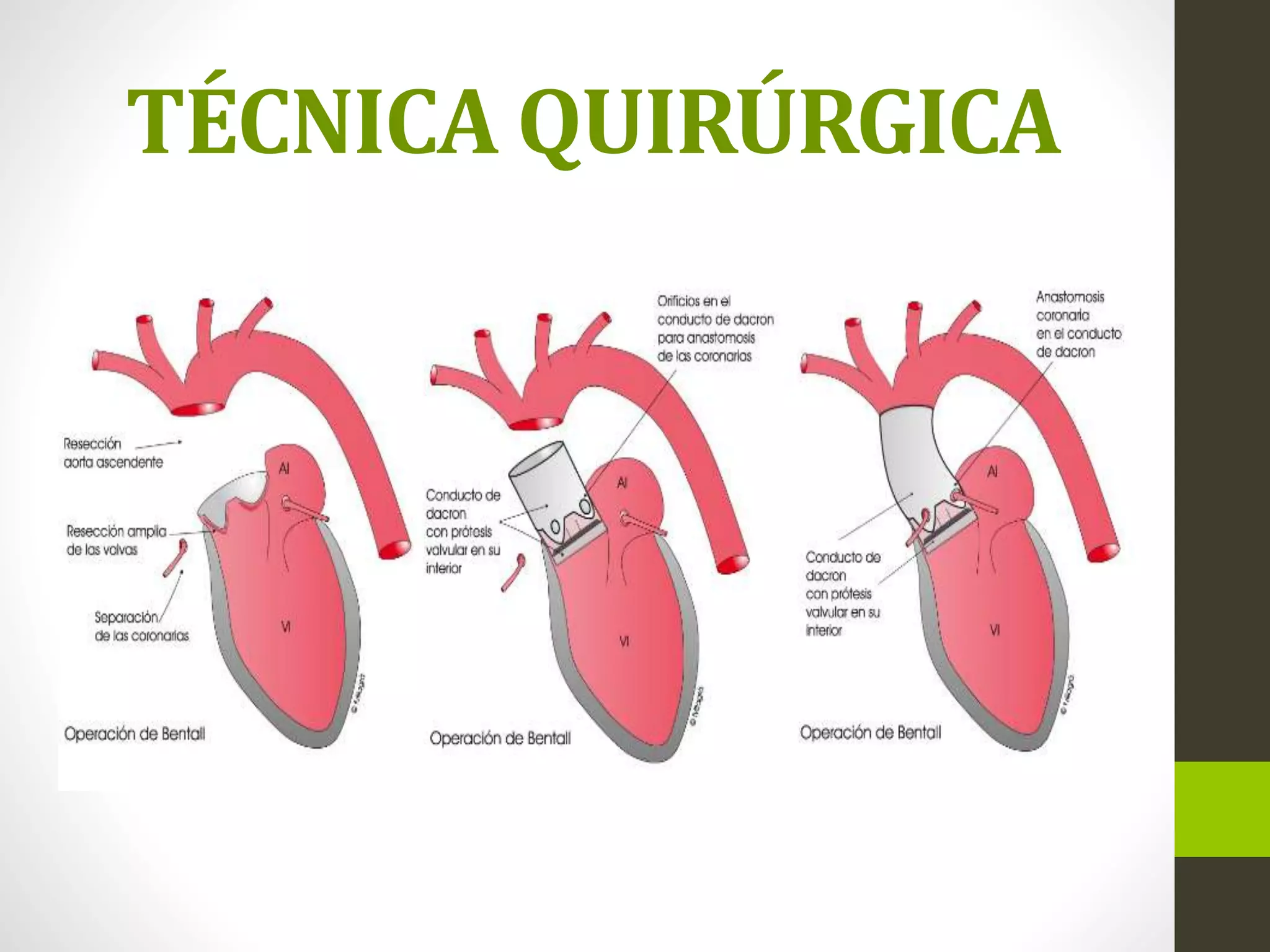 CirugÍa de Bentall Bono | PPTX | Heart and Cardiovascular Diseases ...