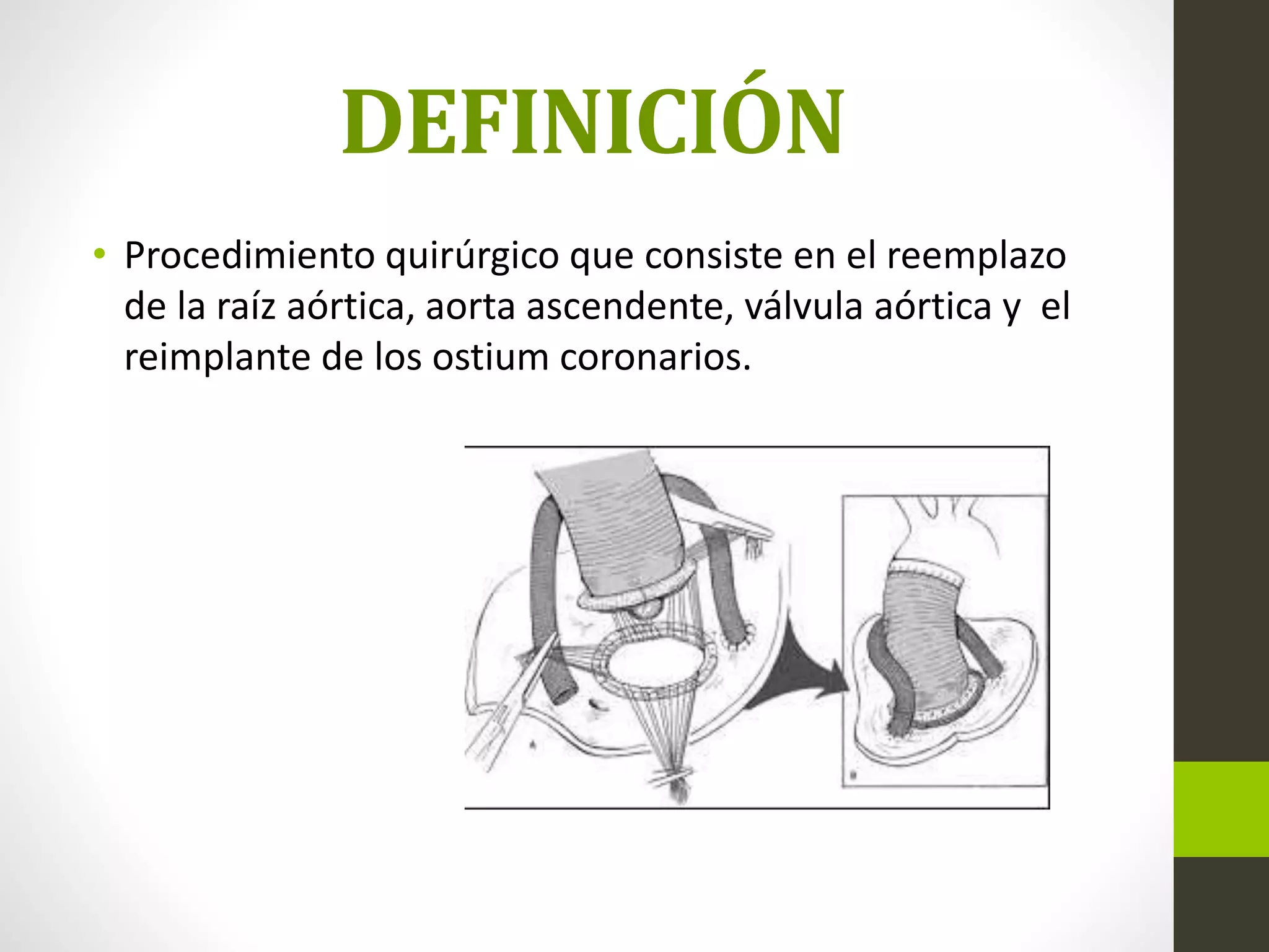 CirugÍa de Bentall Bono | PPTX | Heart and Cardiovascular Diseases ...
