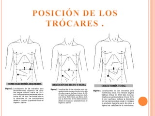 Cirugia de colon para instrumentadores via laparoscopica | PPTX