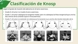 cirugia de hipofisis anestsiologia .pptx