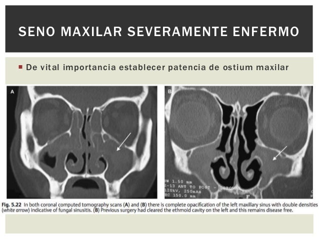Cirugia de seno maxilar y etmoidal