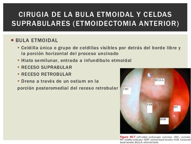 Cirugia de seno maxilar y etmoidal
