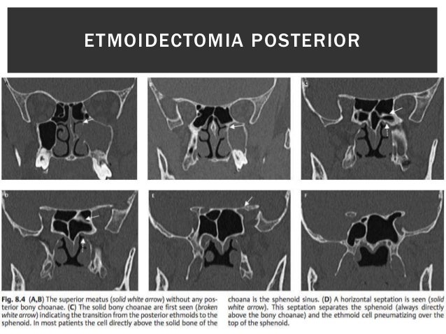 Cirugia de seno maxilar y etmoidal