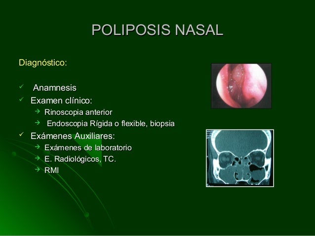 Cirugia endoscopica en poliposis nasal