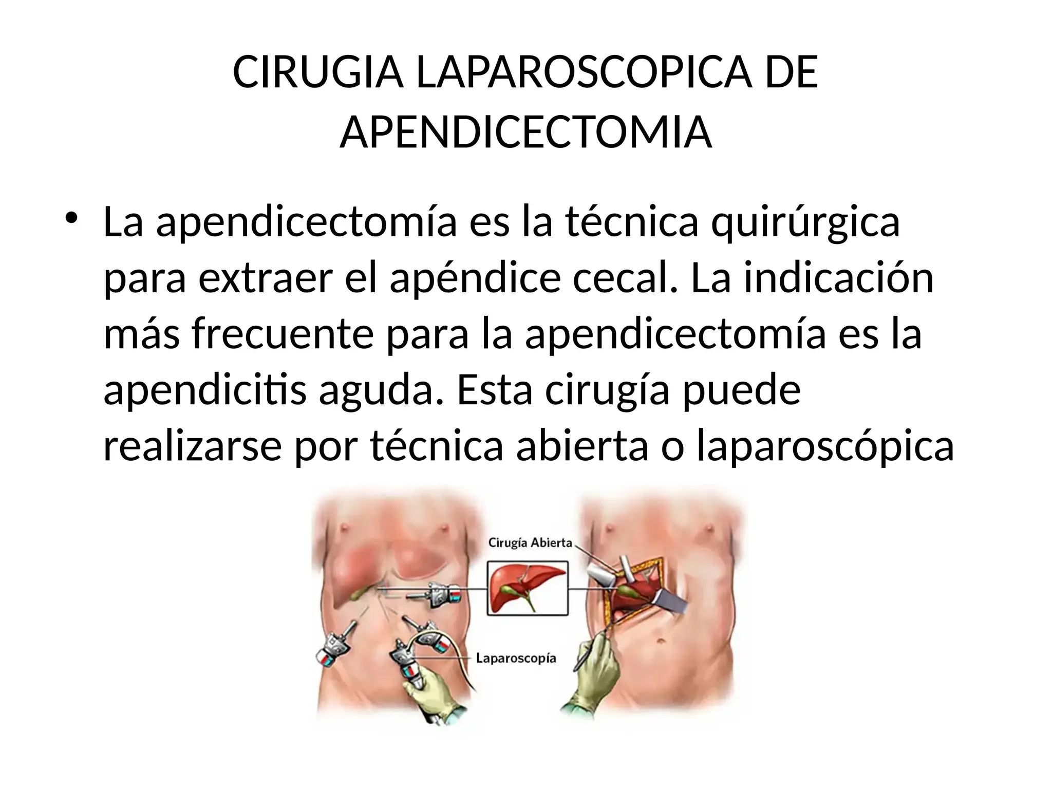 CIRUGIA LAPAROSCOPICA DE APENDICECTOMIA.pptx
