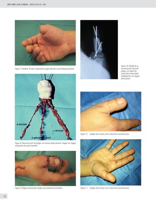 Cirugia reconstructiva de la mano | PDF