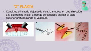 Cirugias pre protesicas | PPTX
