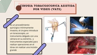 cirugia toracica apuntes generales de salud.pdf