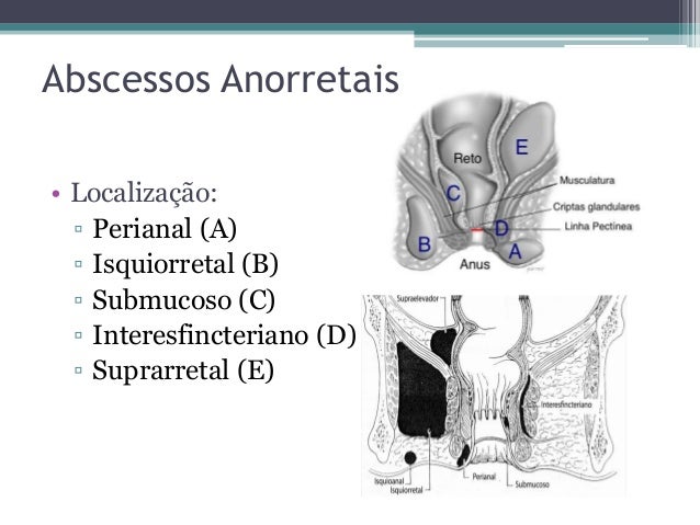 Anatomia Do Abscesso Anorretal