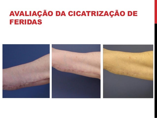 Cicatrização de Feridas em Cirurgia