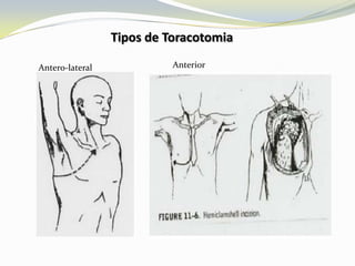 Cirurgia toracica | PPT