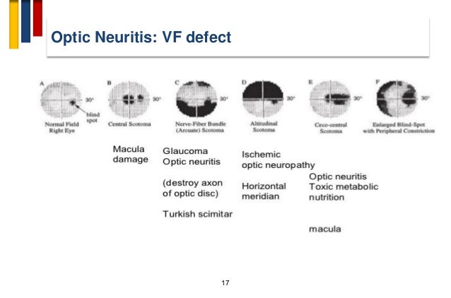 clinically isolated syndromes