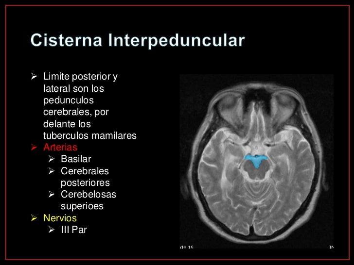Cisterna Perimesencefalica EPOS™