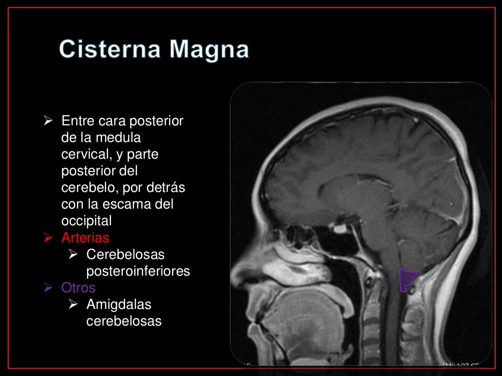 Cisternas del Encefalo