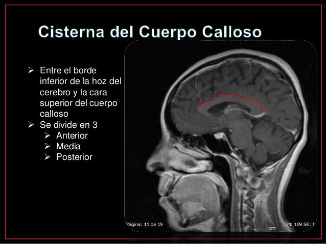 Cisternas Cerebrales