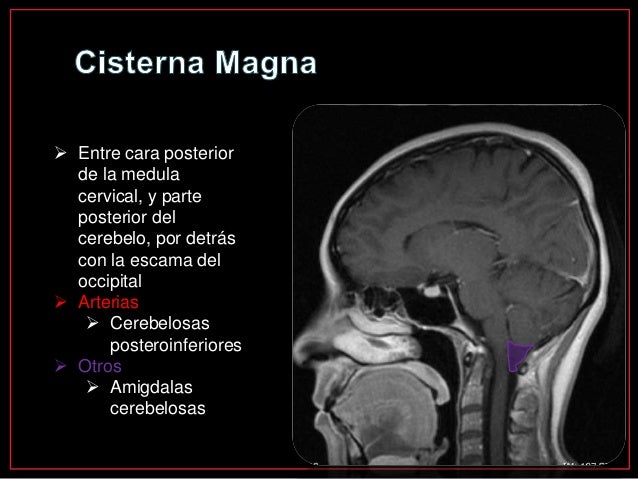Cisternas Cerebrales