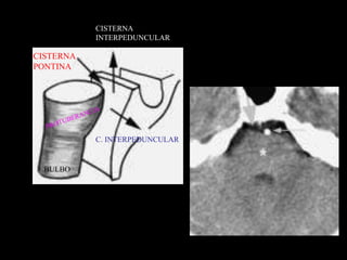 Cisternas-Espacio Subaracnoideo | PPTX